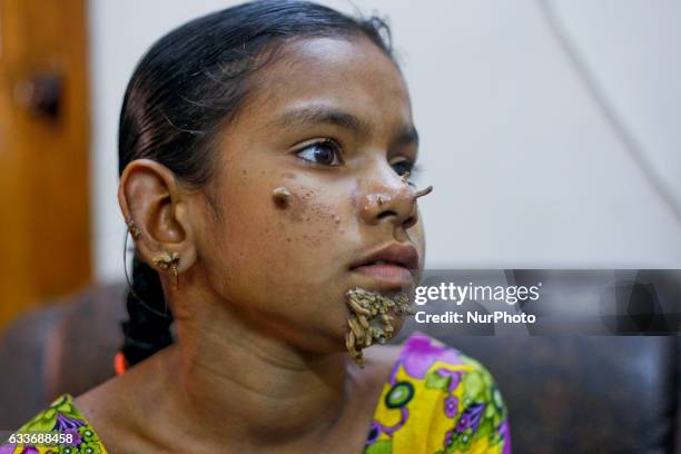 Tree Man Syndrome A Rare Genetic Hereditary Skin Disorder Photos And