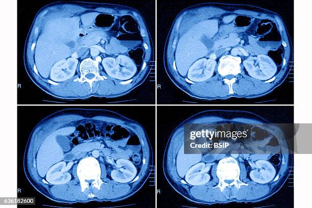 Ct Scan Liver Stock Fotos Und Bilder Getty Images