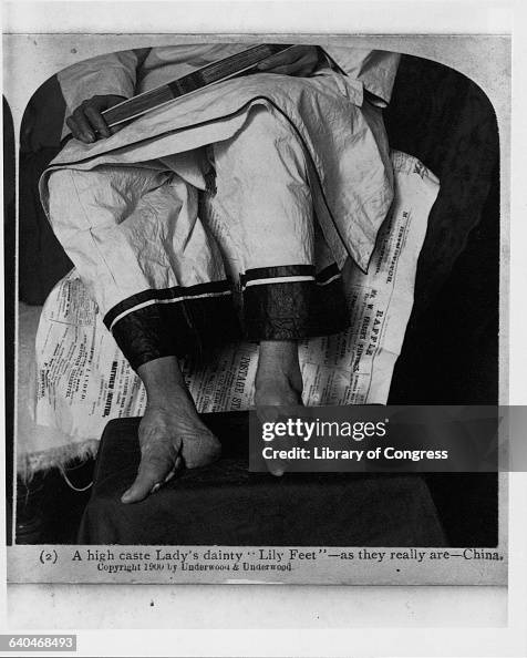 A Chinese Woman Shows Her Deformed Bound Feet Foot Binding Was A