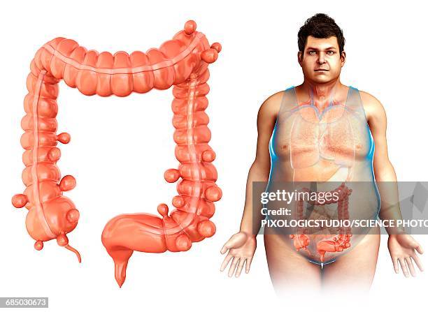 Diverticulosis Illustration High Res Vector Graphic Getty Images