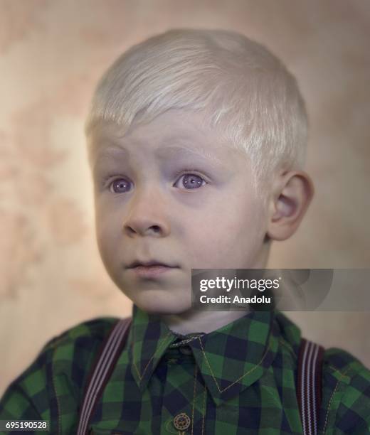 Albino Person Red Eyes