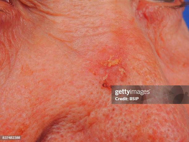 Basal Cell Carcinoma Photos Photos And Premium High Res Pictures Getty Images