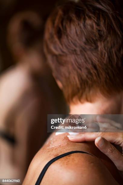 Sunburn Blister Photos And Premium High Res Pictures Getty Images