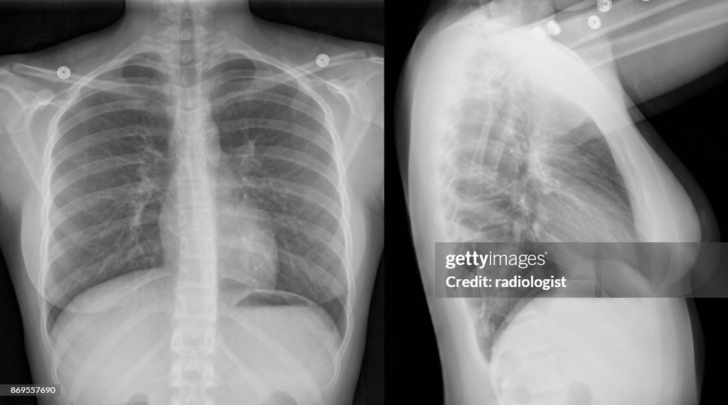 Normal Infant Chest Xray