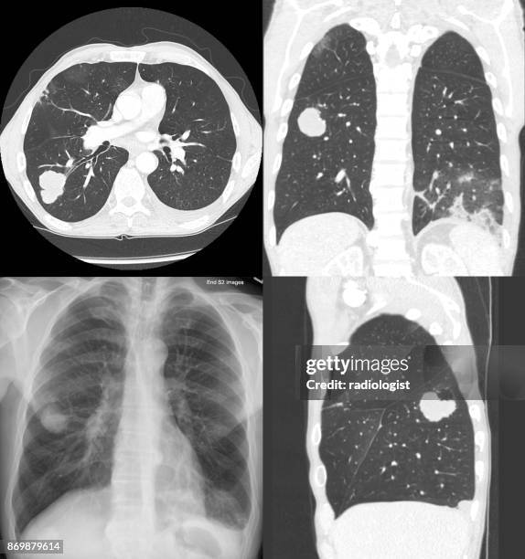 Lung Tomography Fotografías E Imágenes De Stock Getty Images