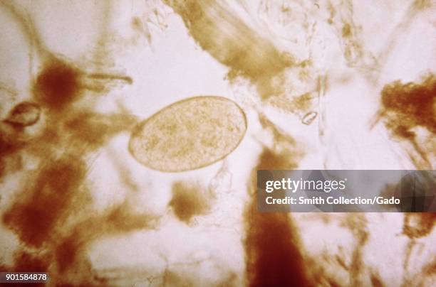 Fluke Worm In Stool