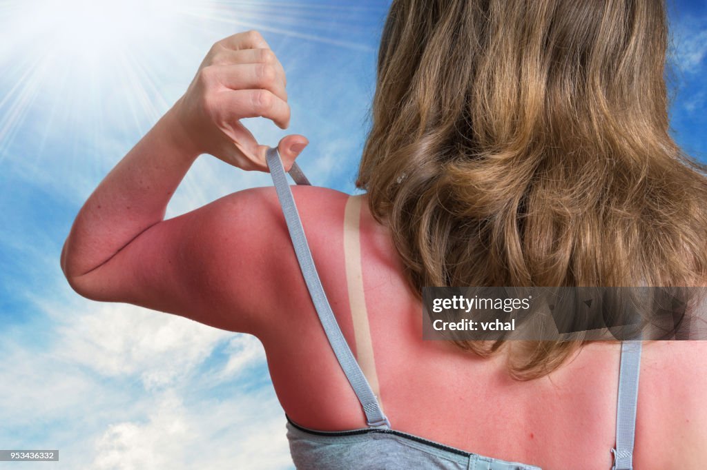 Sunburn Concept Young Woman With Red Sunburned Skin On Her Back High