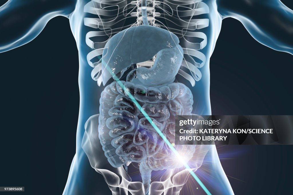 Colon Cancer Treatment Conceptual Illustration High Res Vector Graphic